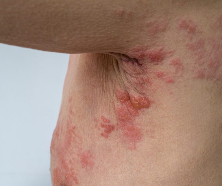 Comprendre le zona : Causes, symptômes et traitements - Révélations ...